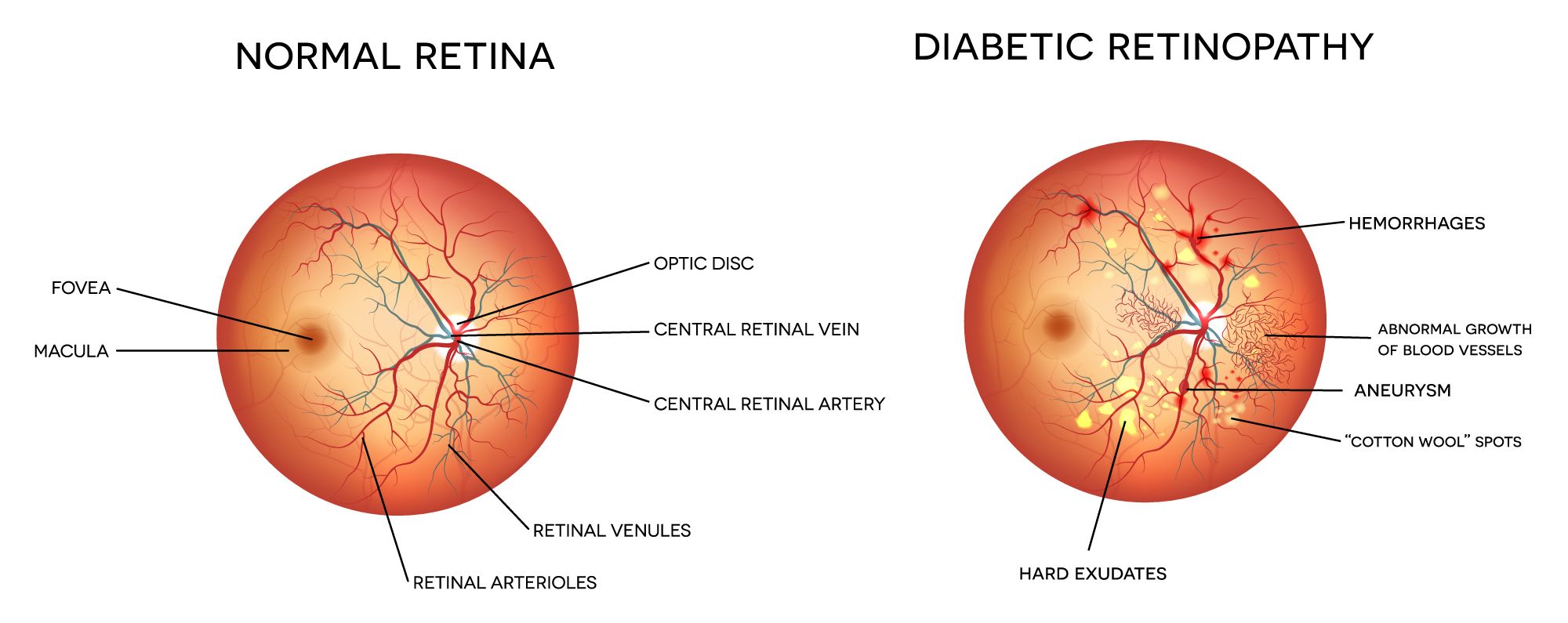 Diabetic Retinopathy And Vitrectomy Monterey CA