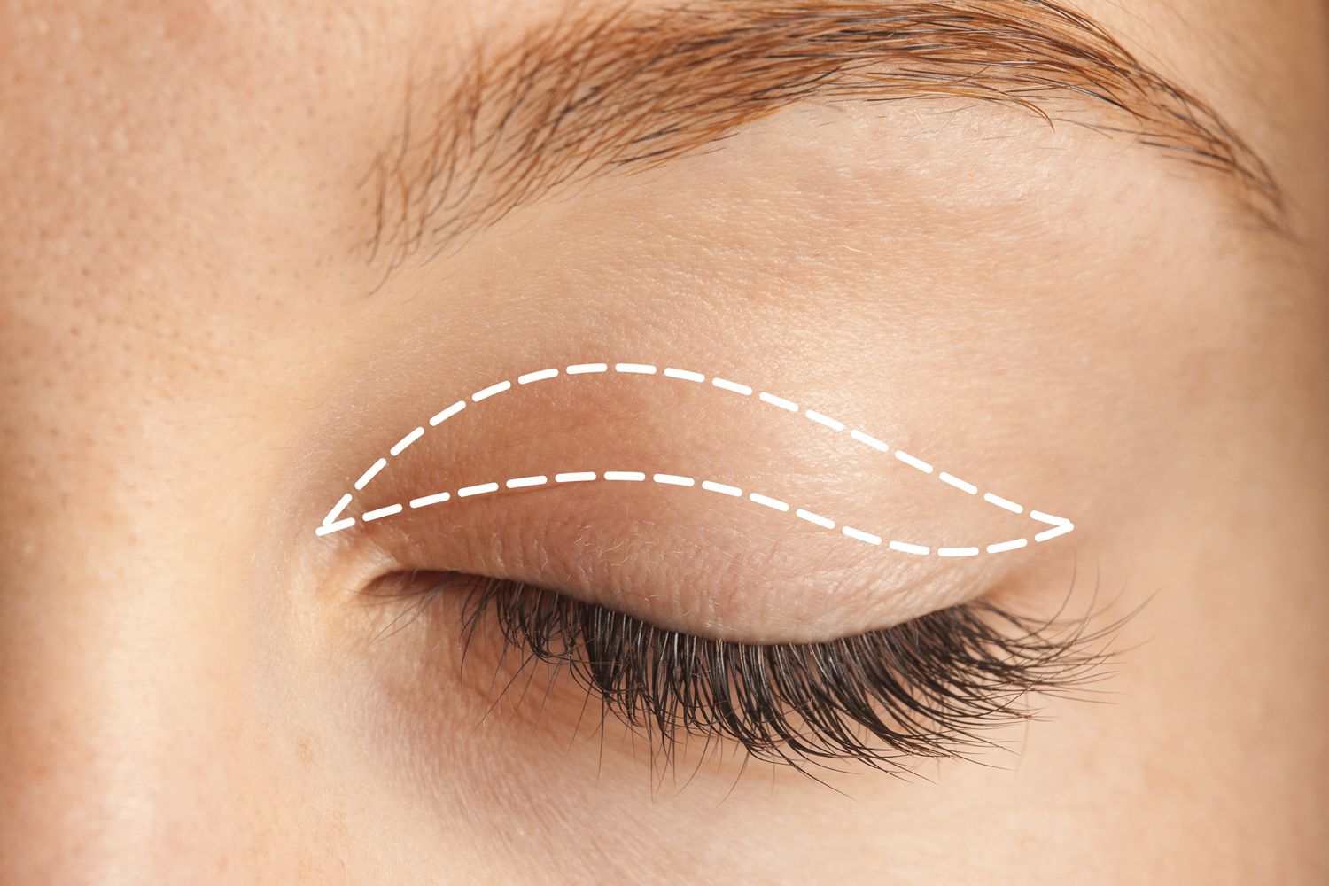 Upper Eyelid Surgery For Hooding Ottawa ON