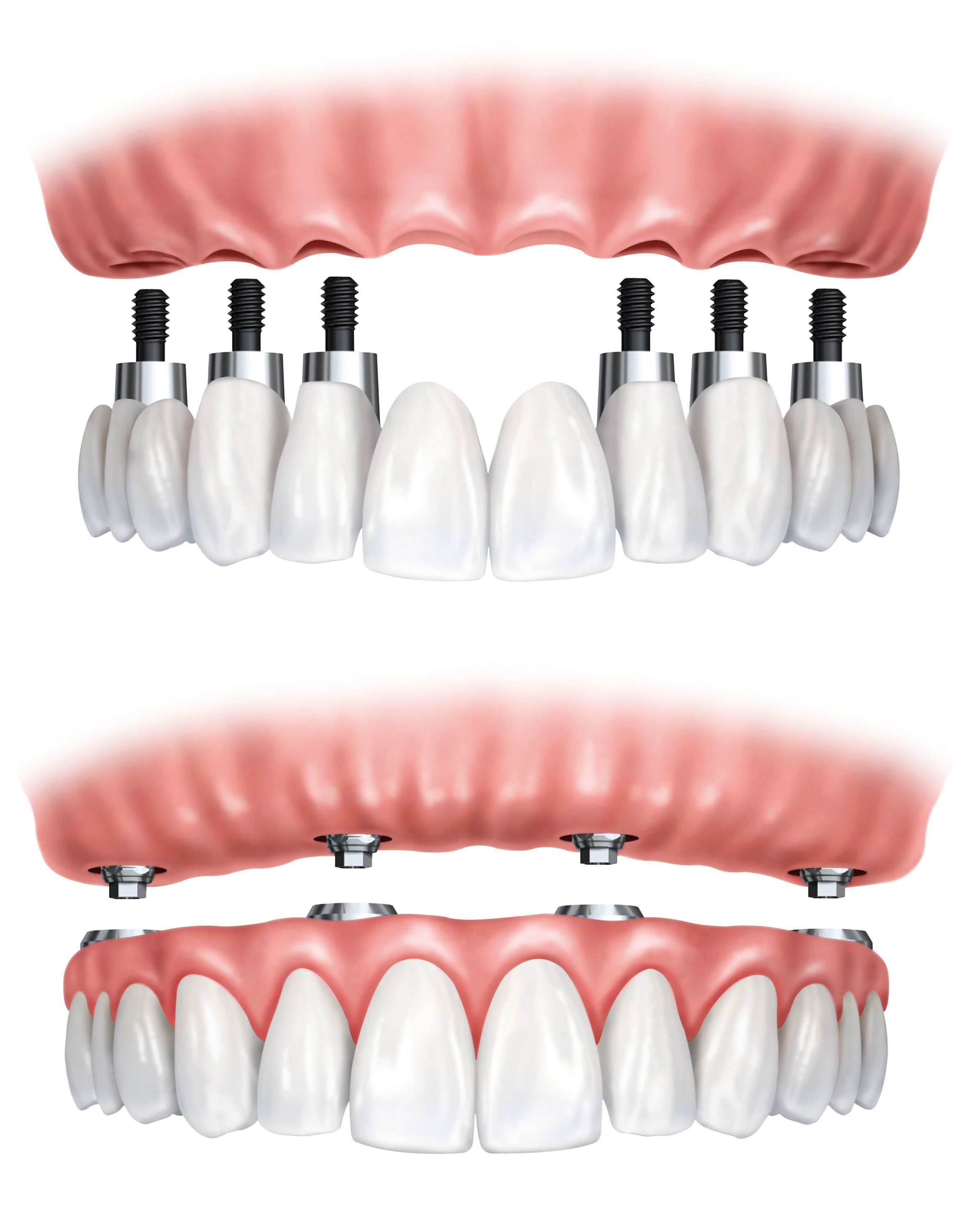 Treatments For Missing Teeth Tijuana Mexico
