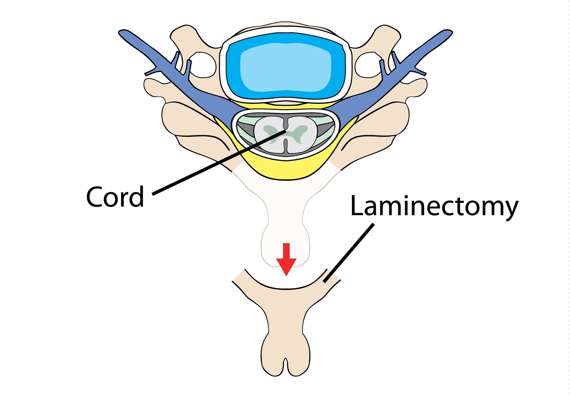 Laminectomy Cedar Park TX Austin TX Spinal Decompression