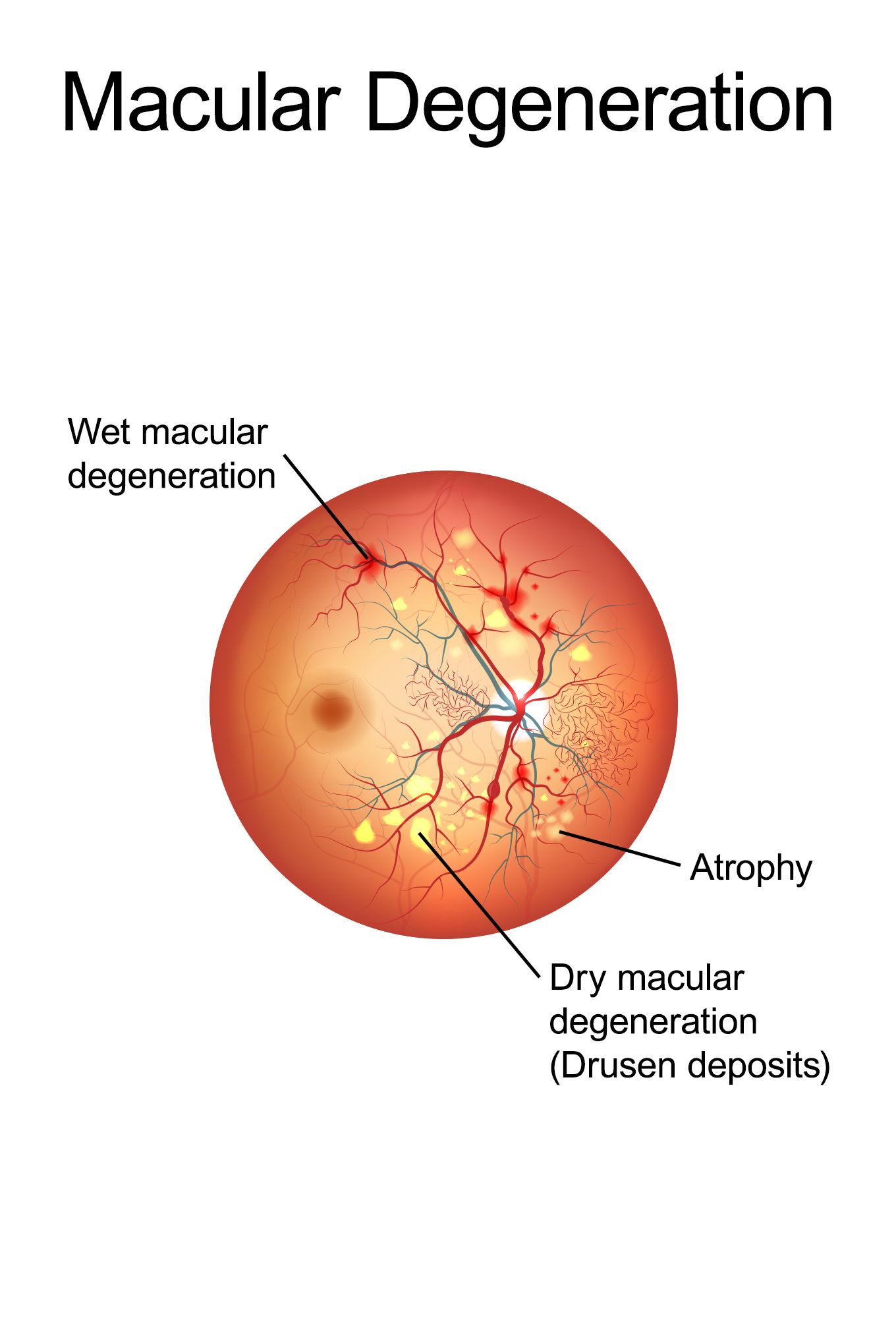 Wet Vs Dry Macular Degeneration Detroit MI Dr Thomas Byrd