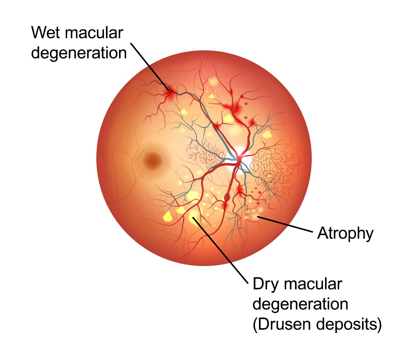 Benefits Of Early Macular Degeneration Diagnosis La Jolla CA