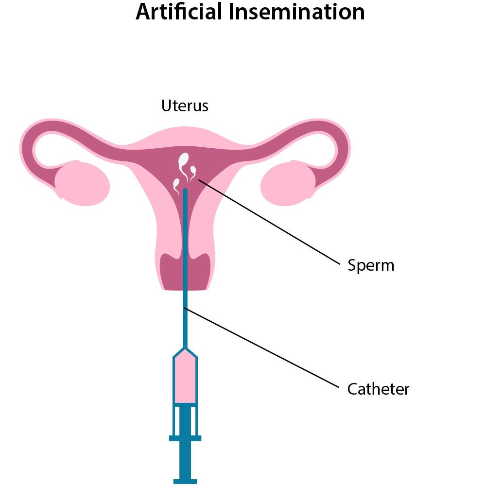 What Are The 4 Types Of Artificial Insemination At Angel Singleton Blog What Are The 4 Types Of Artificial Insemination At Angel Singleton Blog