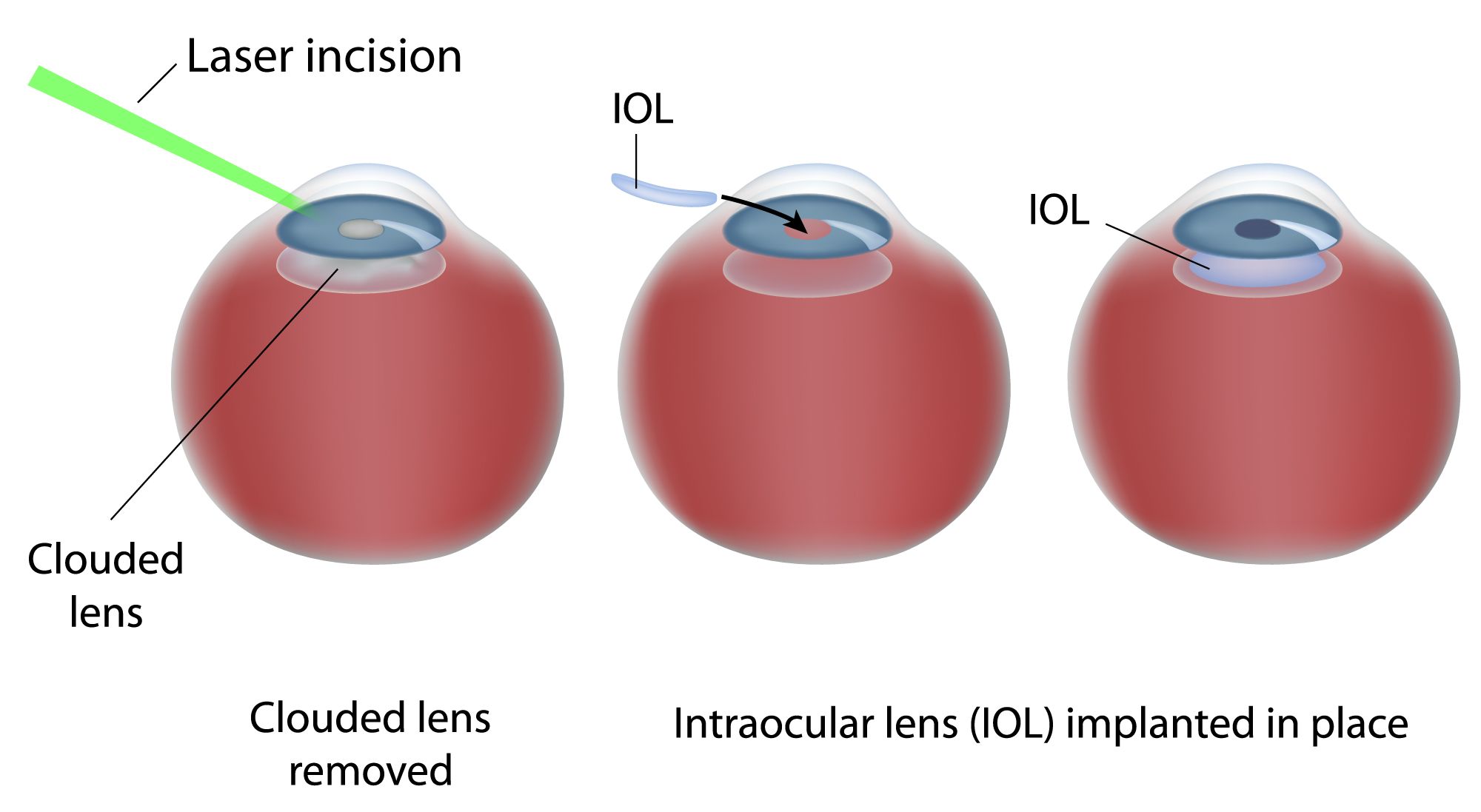 Does Medicare Cover Laser Cataract Surgery Detroit MI