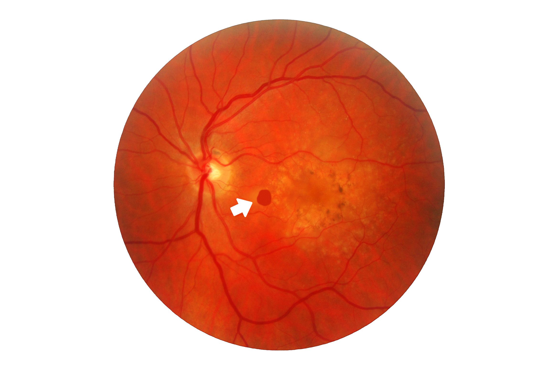 Dry Age Related Macular Degeneration Chicago IL AMD Causes Symptoms 